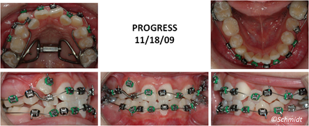 ROHIT SACHDEVA: Patient LJ: Class I Initial and Treatment progress (11 ...